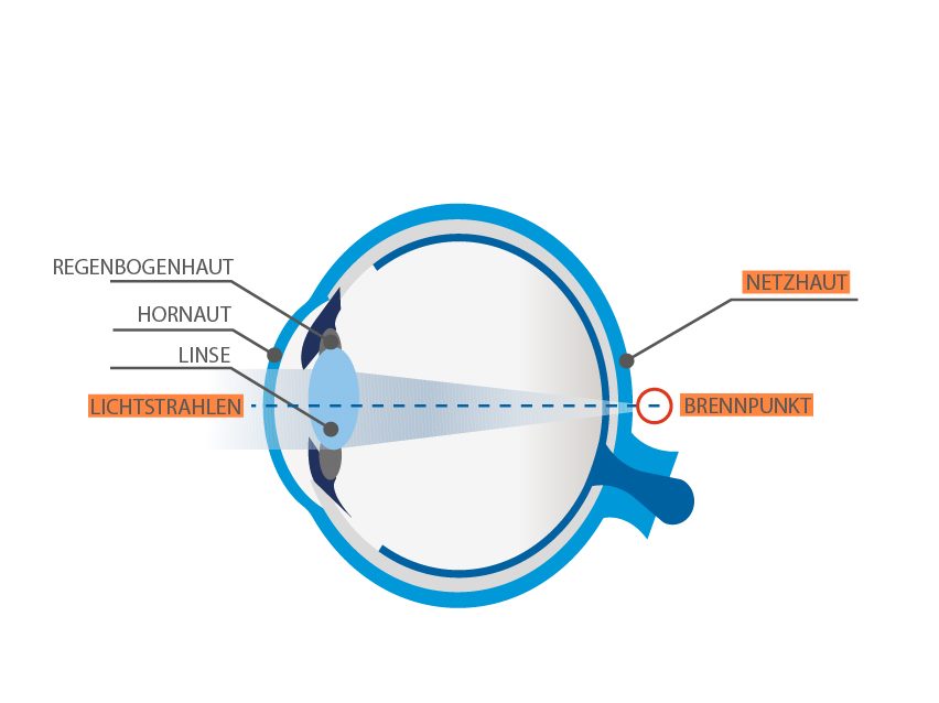 Weitsichtigkeit Lasern: Korrektur von Hyperopie | CARE Vision